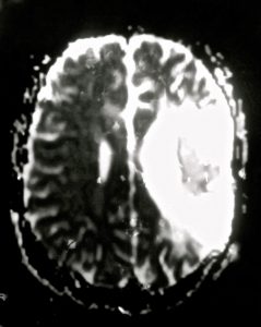 Global Aphasia: What is it and how to help communication after stroke